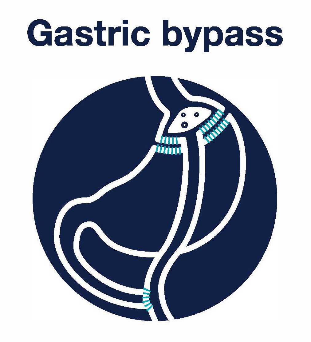 Laparoscopic Gastric Bypass | Surgical Skills Center